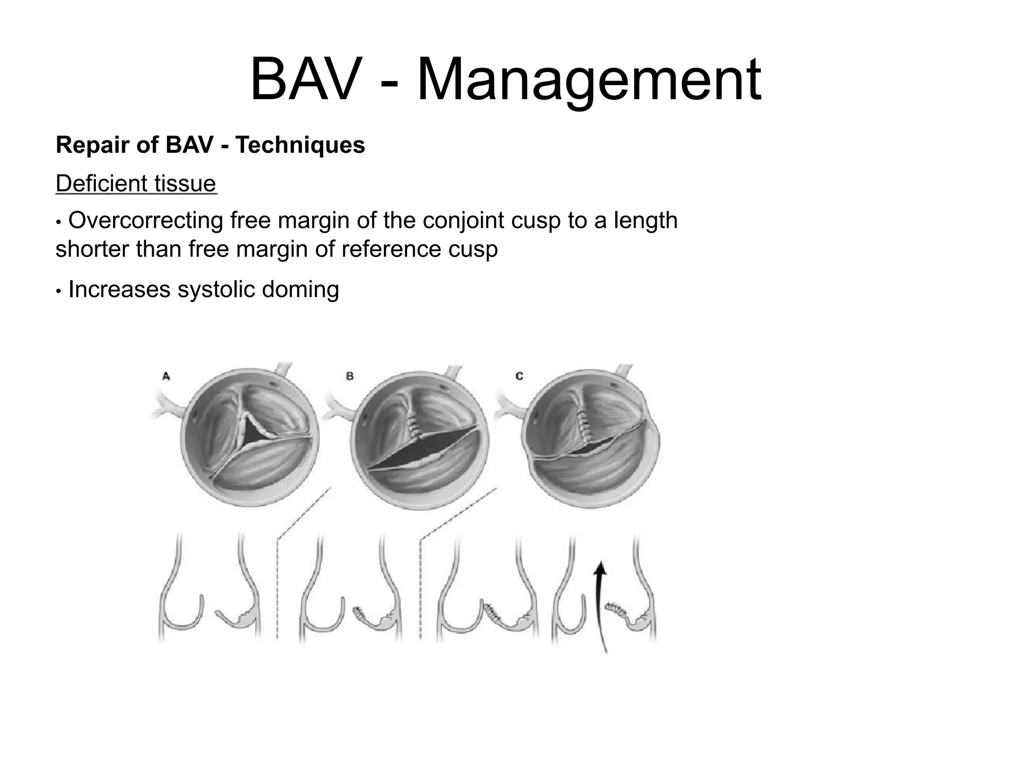 Bicuspid Aortic Valve Ppt