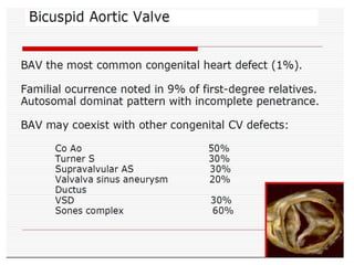 Bicuspid Aortic Valve