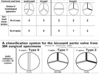 Bicuspid Aortic Valve Types