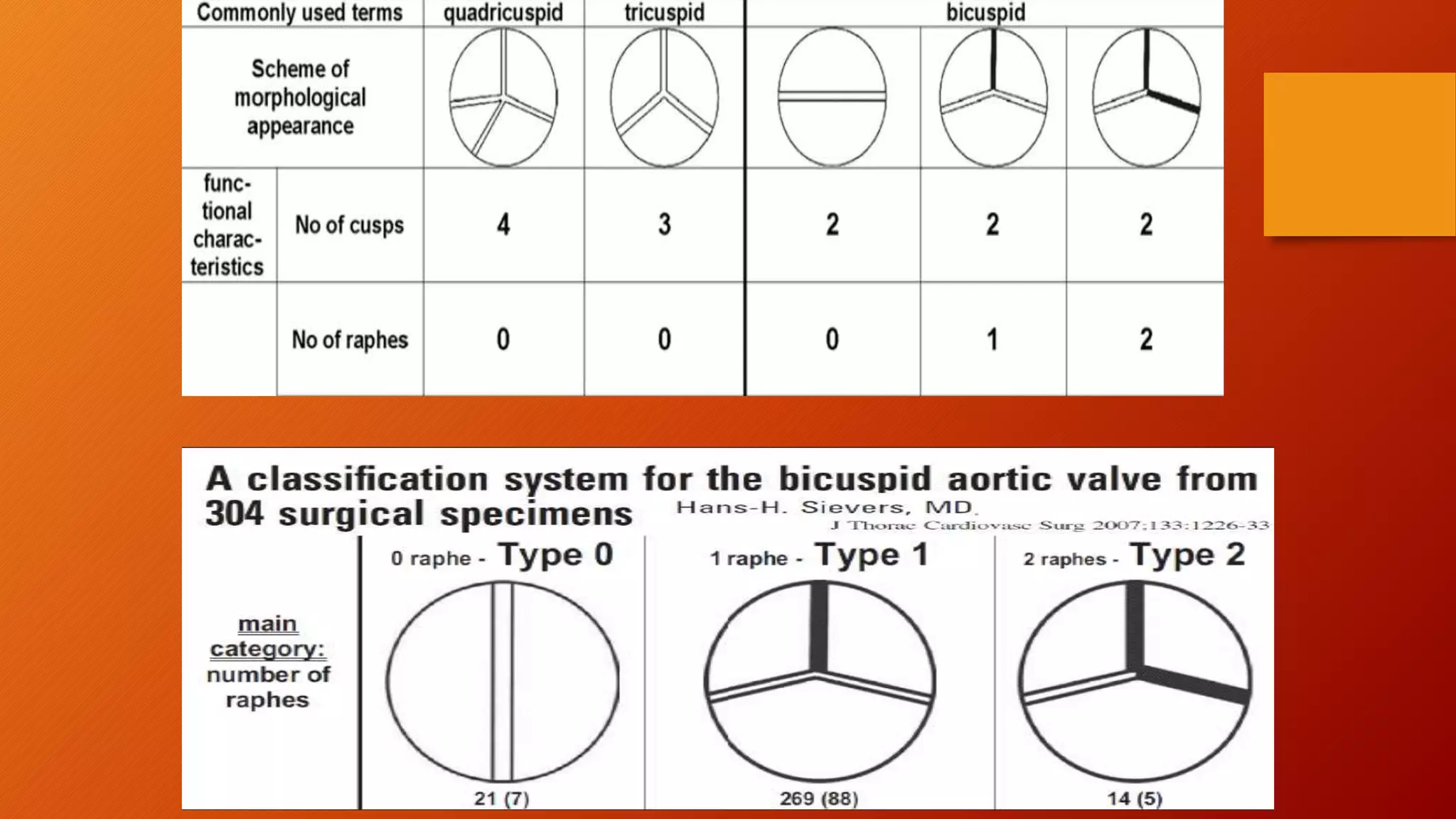 Bicuspid aortic valve | PPTX