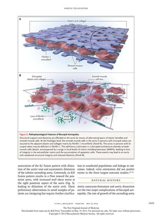 Bicuspid aortic valve pattern | PDF