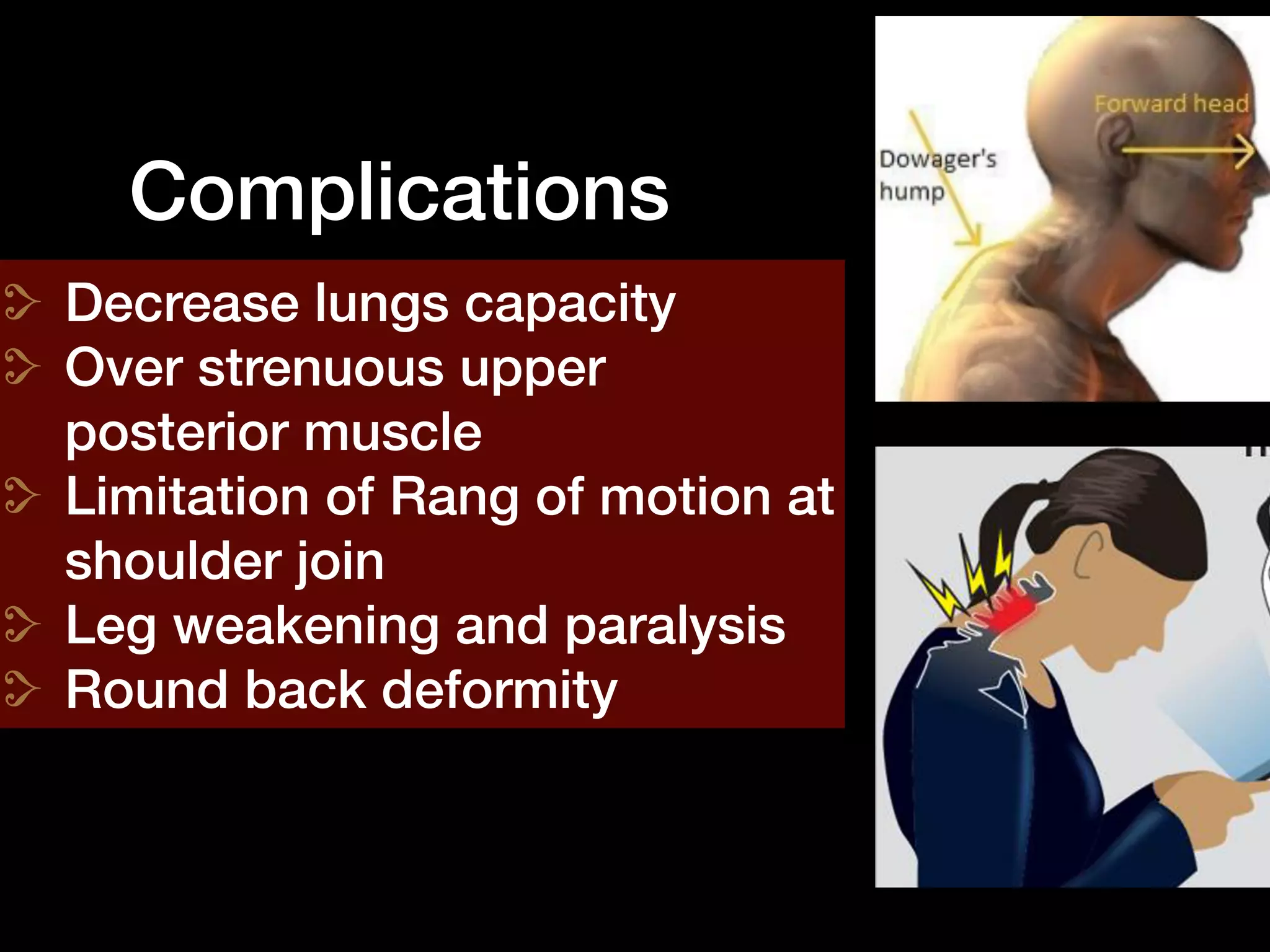 Posture and kyphosis_ | PDF