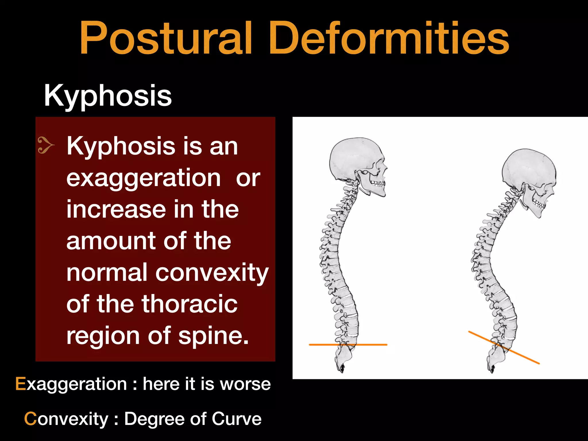 Posture and kyphosis_ | PDF