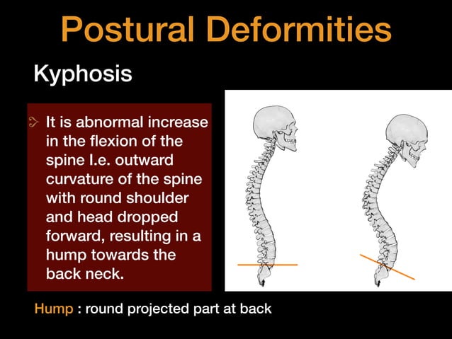 Posture and kyphosis_ | PDF | Physical Therapy | Wellness