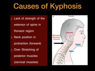Posture and kyphosis_ | PDF
