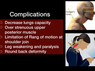 Posture and kyphosis_ | PDF