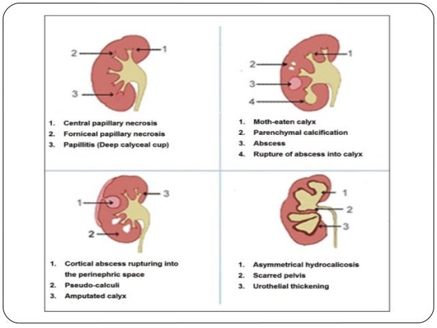 Imaging of Urinary tract TB