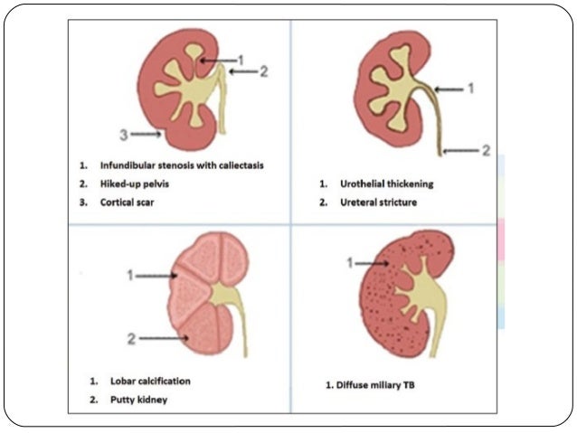 Imaging of Urinary tract TB