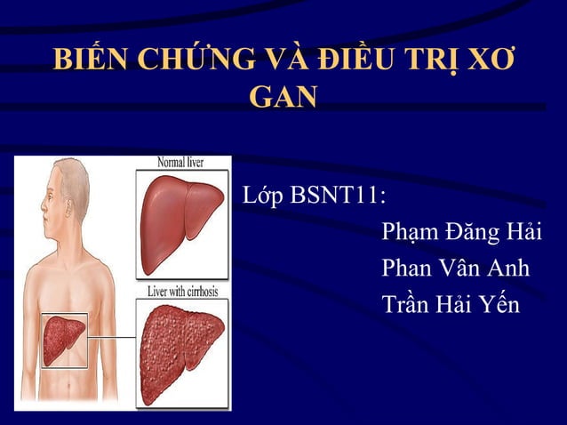 Bien chung va dieu tri xo gan | PPT