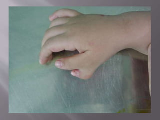 bifid thumb from zero to hero treatment .pptx