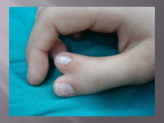 bifid thumb from zero to hero treatment .pptx