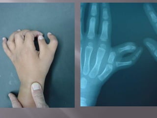 bifid thumb from zero to hero treatment .pptx
