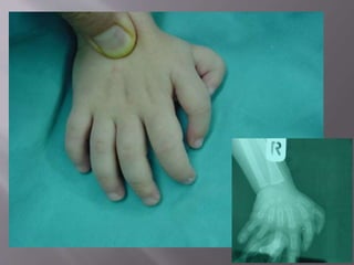 bifid thumb from zero to hero treatment .pptx