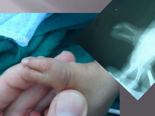 bifid thumb from zero to hero treatment .pptx