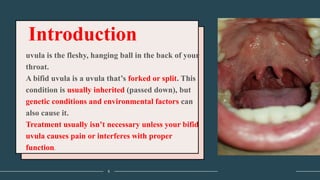 Bifid Uvula in childern , dono t take lightly, .pptx