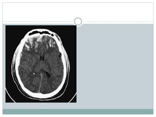 Bifrontal contusions | PPTX