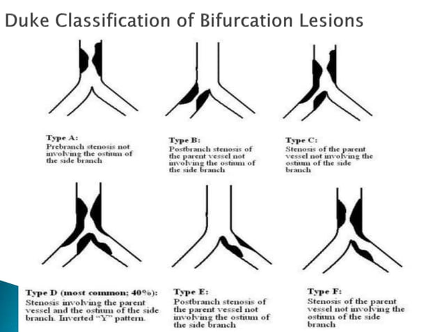 Bifurcation lesions | PPTX