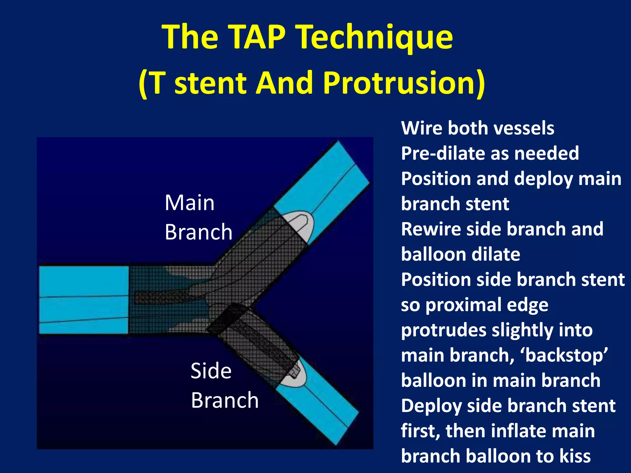 Bifurcation lesions | PPTX