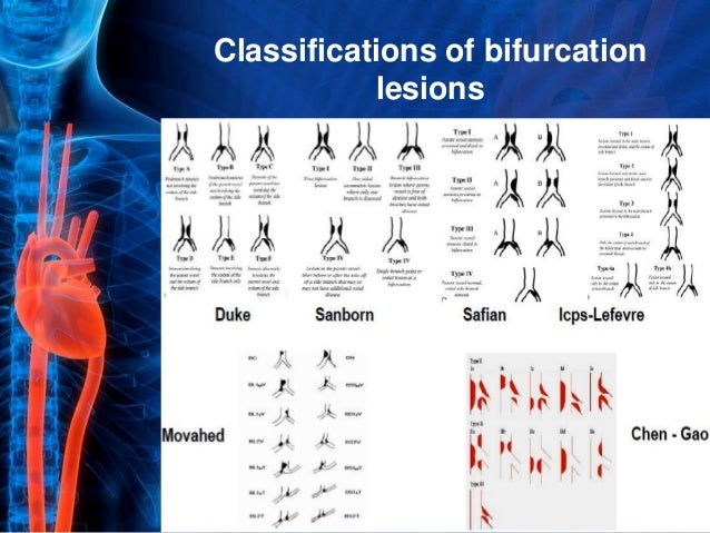a case of Bifurcation Stenting- Dr Zarrar