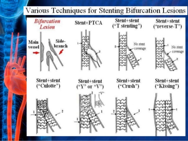 a case of Bifurcation Stenting- Dr Zarrar