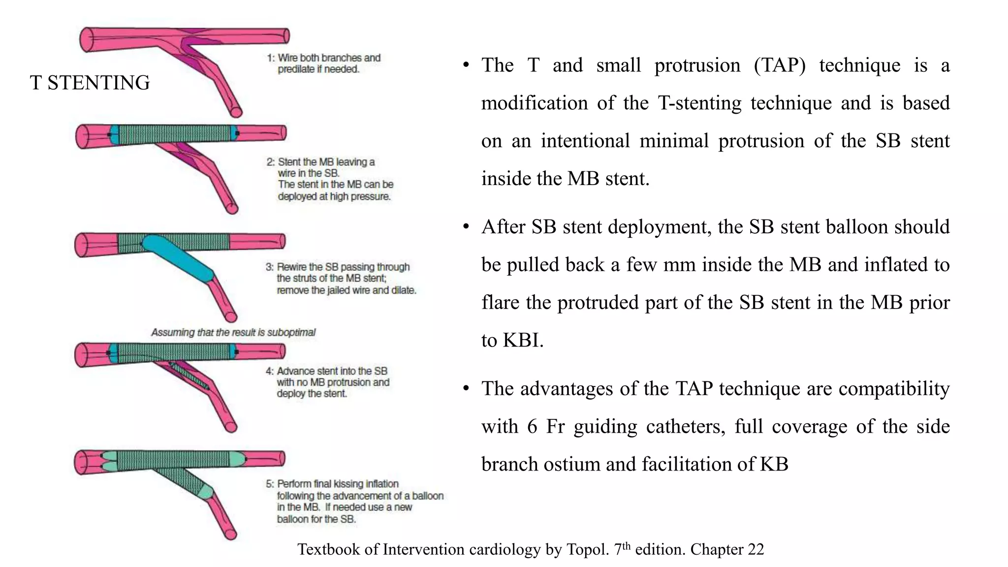 Bifurcations stenting | PPTX