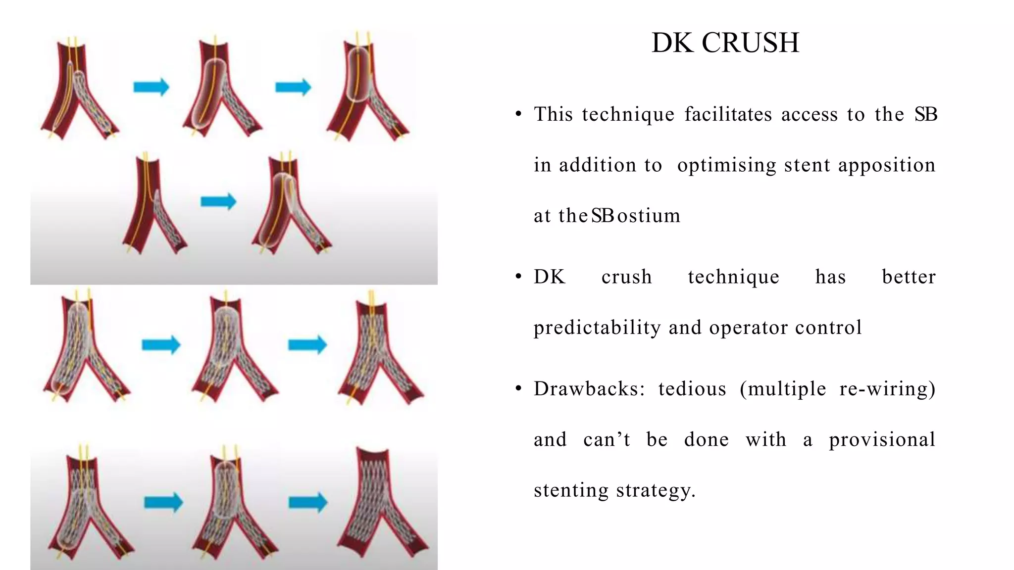 Bifurcations stenting | PPTX