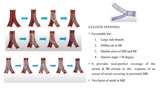 Bifurcations stenting | PPTX | Heart and Cardiovascular Diseases ...