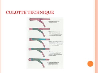 Bifurcation stenting | PPT