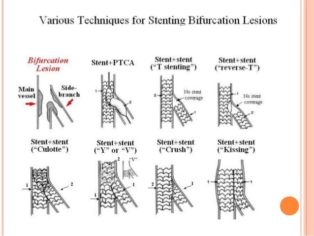 Bifurcation stenting