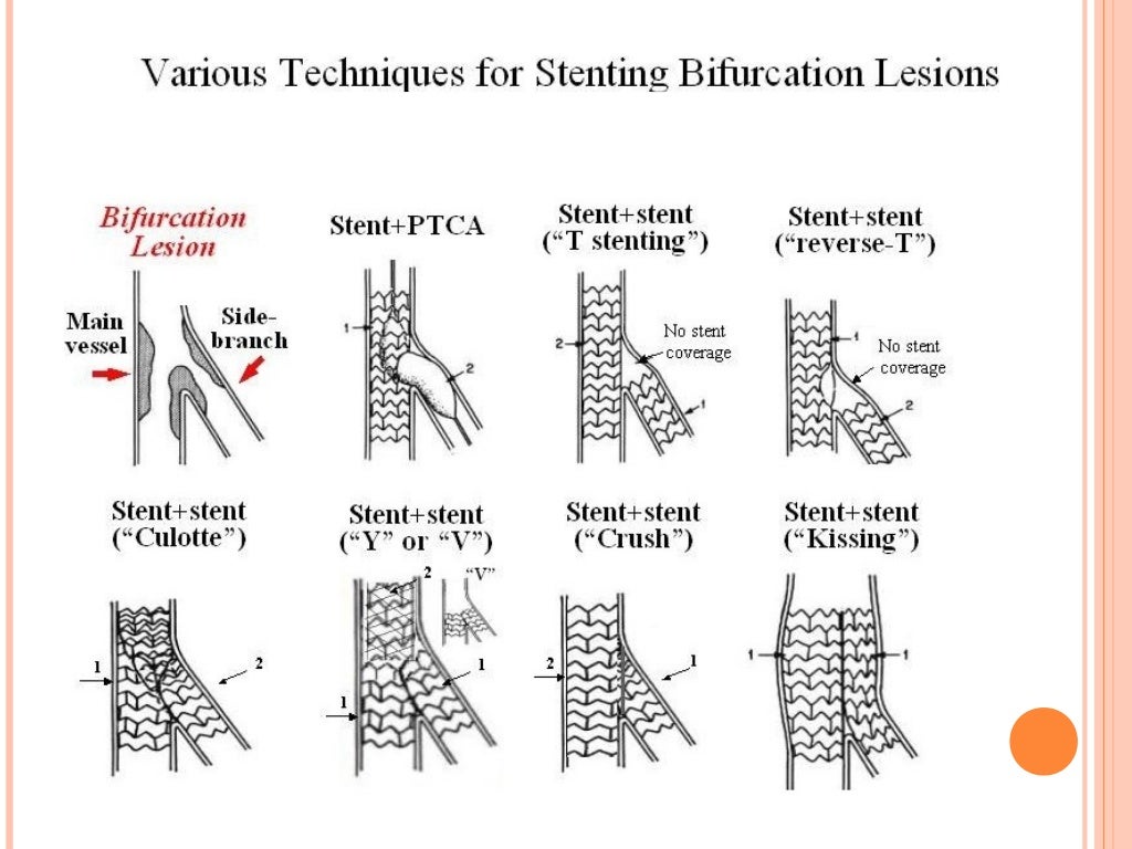 Bifurcation stenting