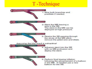 Bifurcation stenting | PPTX
