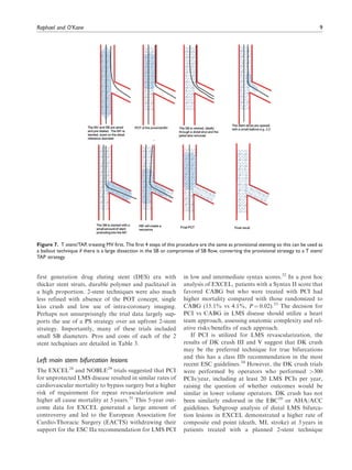 Bifurcation stenting | PDF
