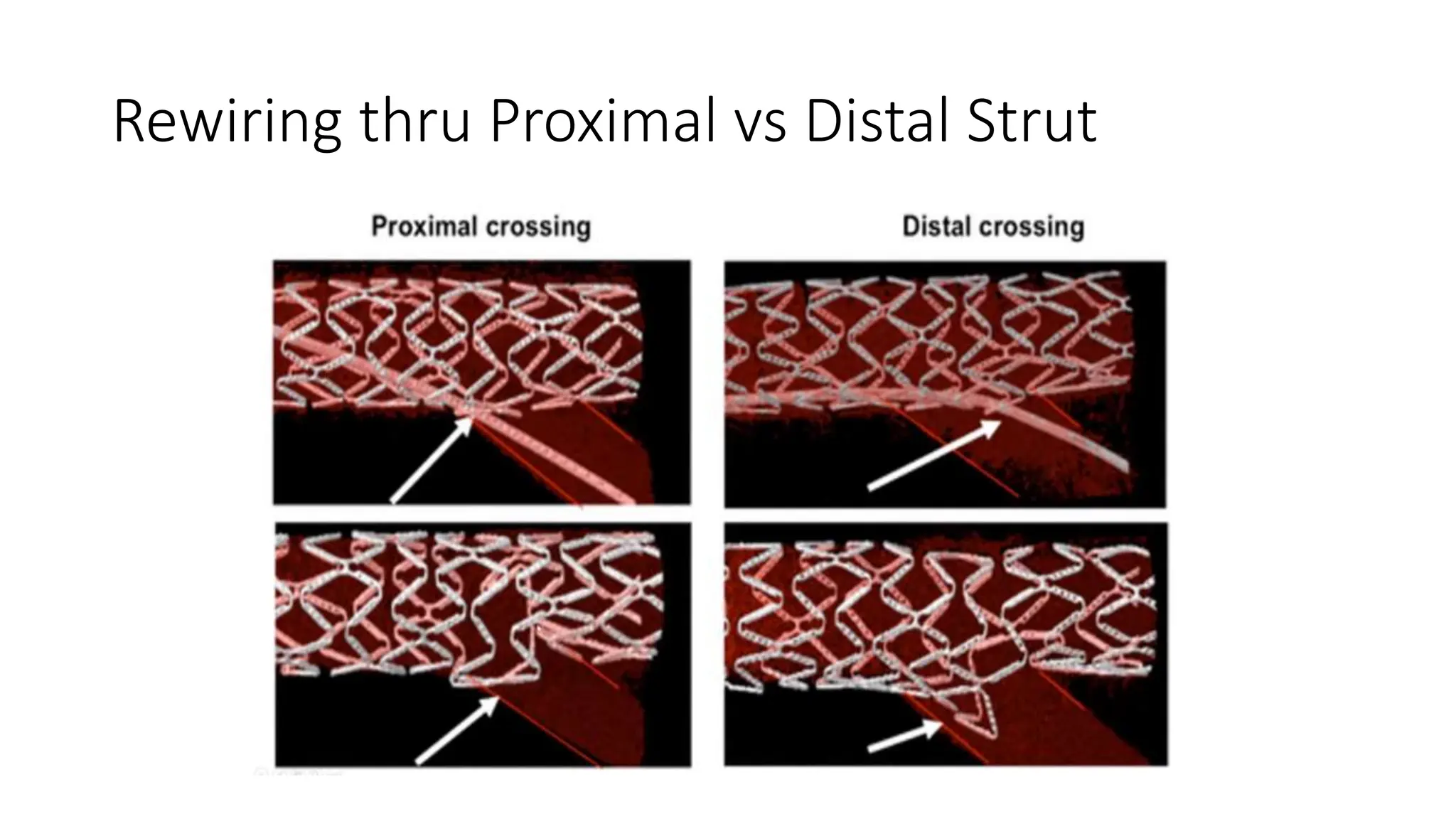 Bifurcation Stenting - BASICS.DR SADDAM HUSSAIN PGR CARDIOLOGY,MTI LRH.pptx