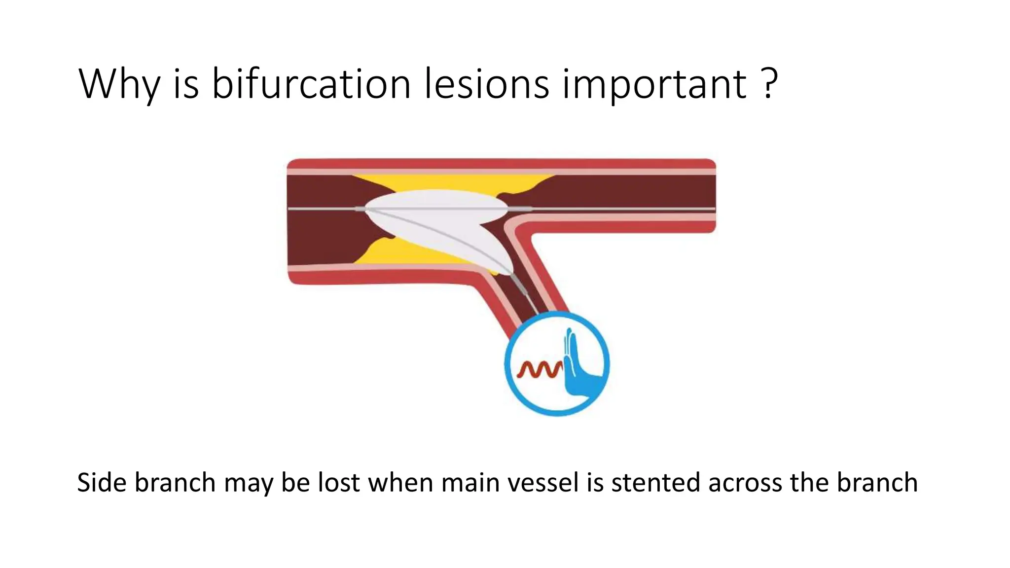 Bifurcation Stenting - BASICS.DR SADDAM HUSSAIN PGR CARDIOLOGY,MTI LRH.pptx