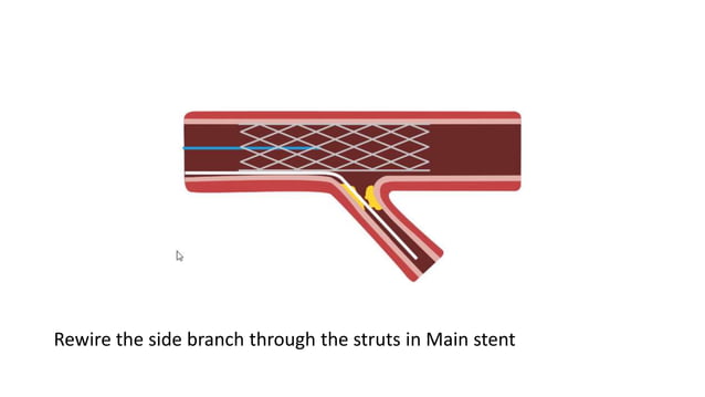 Bifurcation Stenting - BASICS.DR SADDAM HUSSAIN PGR CARDIOLOGY,MTI LRH.pptx