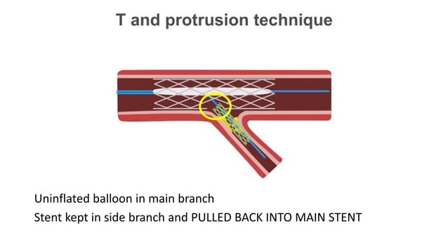 Bifurcation Stenting - BASICS.DR SADDAM HUSSAIN PGR CARDIOLOGY,MTI LRH.pptx