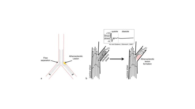 Bifurcation stenting Basics - Dr Hafeesh Fazulu Pushpagiri 28th april ...
