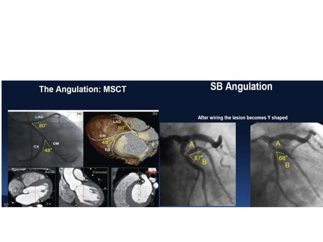 Bifurcation stenting strategies.ppt | Medical Health