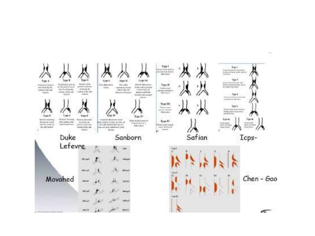 Bifurcation stenting strategies.ppt | Medical Health
