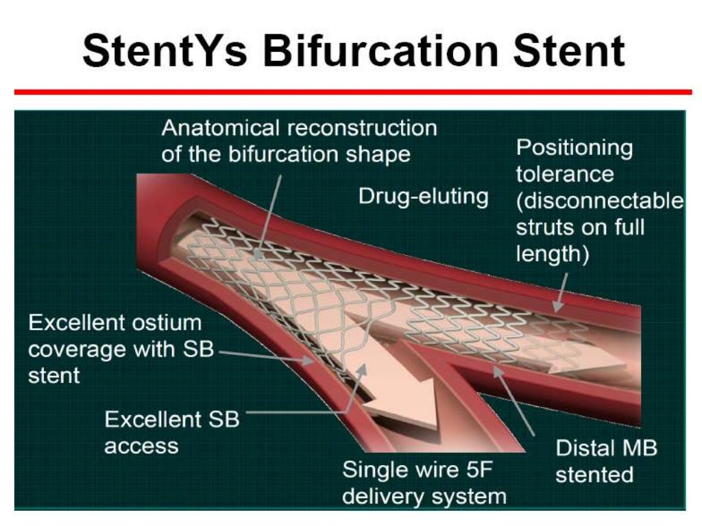 Bifurcation stenting strategies.ppt