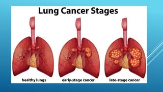 big-C.pdf power for colon and lung cancer presentation | PDF