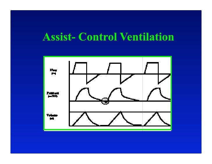 Optimizing Critical Care Ventilation: What can we learn from Ventilat…