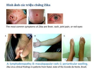 Bài Giảng BỆNH DO VIRUS ZIKA.pdf