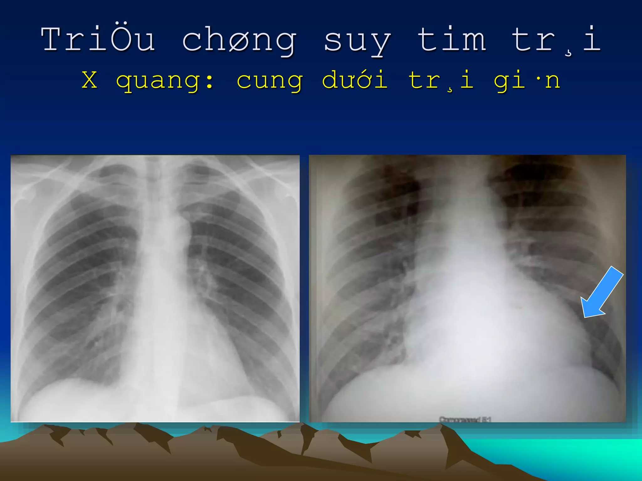 Bài giảng Suy tim BS Cầm.ppt