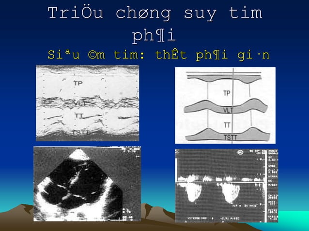 Bài giảng Suy tim BS Cầm.ppt