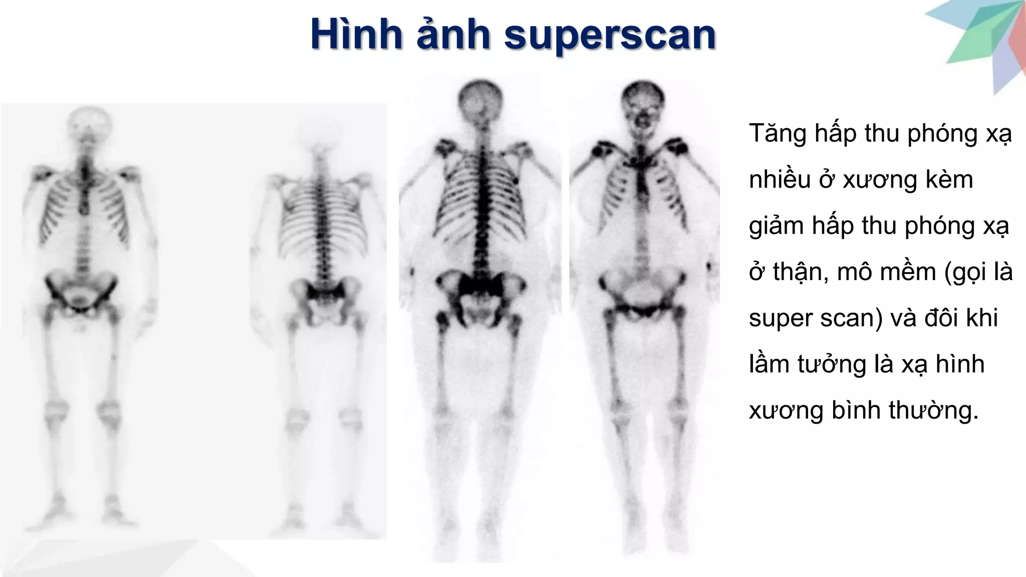 Bài giảng Xạ Hình Xương.pptx