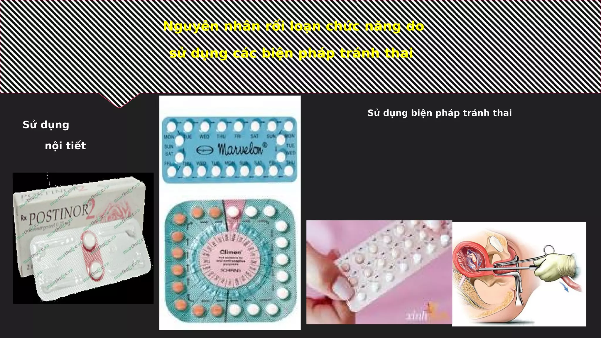 Bài Giảng Xuất Huyết Tử Cung Bất Thường.pdf