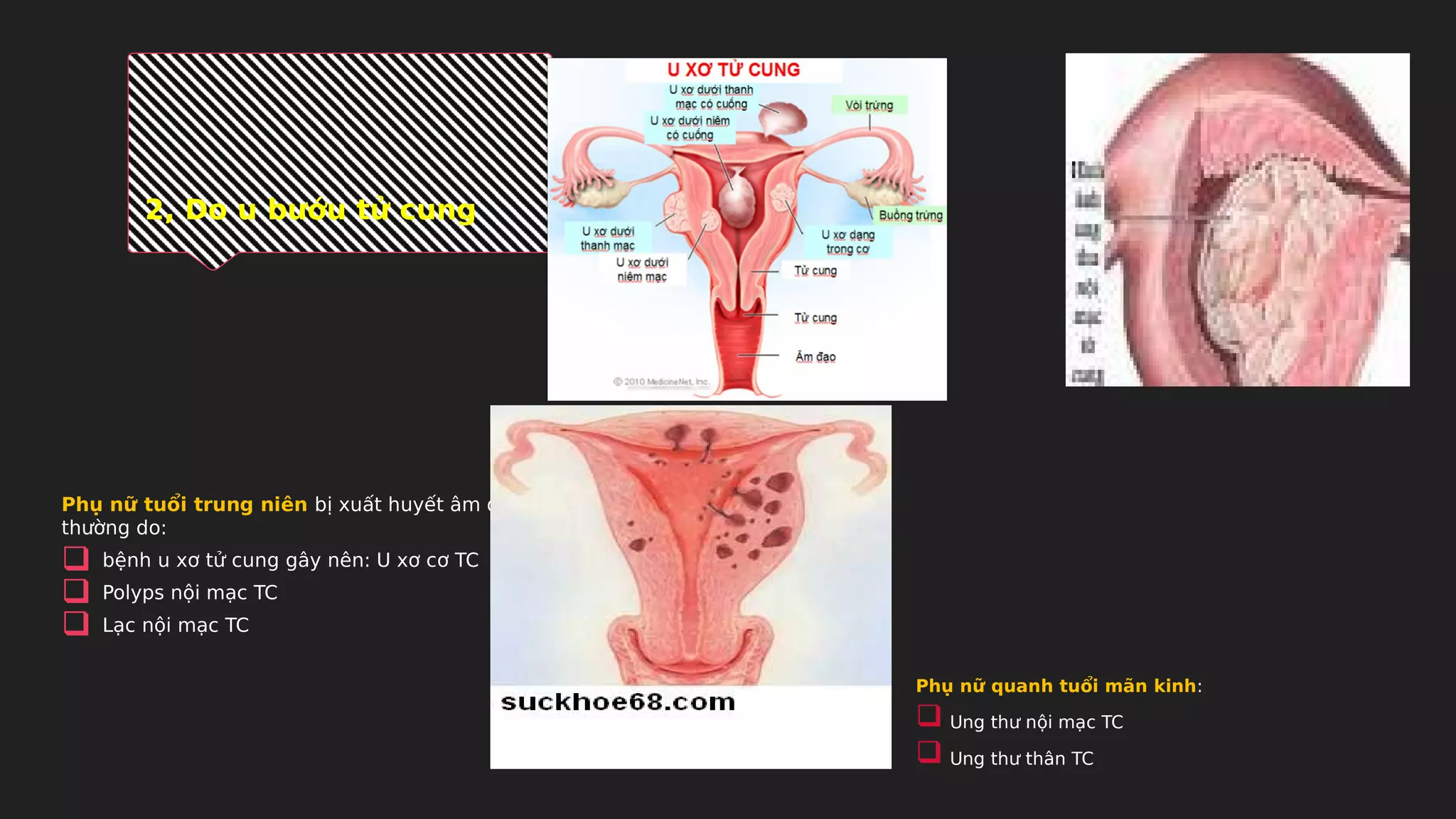 Bài Giảng Xuất Huyết Tử Cung Bất Thường.pdf