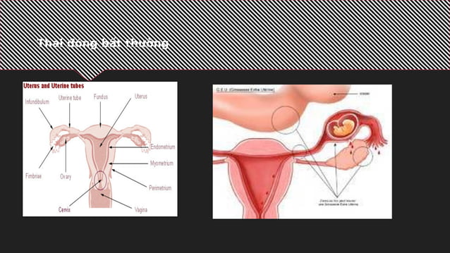 Bài Giảng Xuất Huyết Tử Cung Bất Thường.pdf