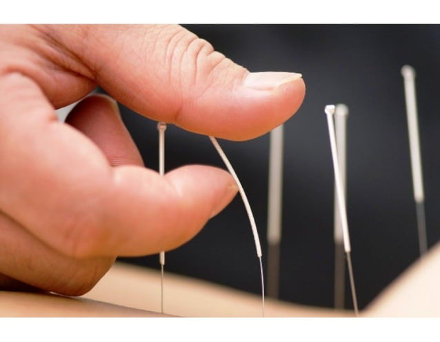 Needling Technique | PDF